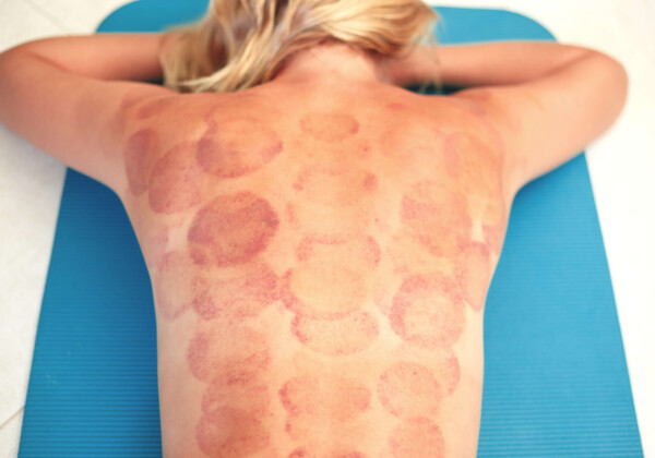 What are cupping marks? – FasciaBuddy